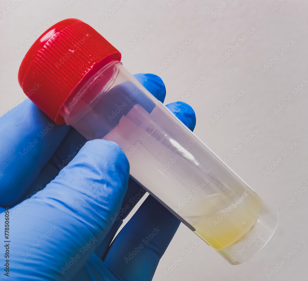 Semen sample for male fertility testing. Semen analysis. Sperm count ...