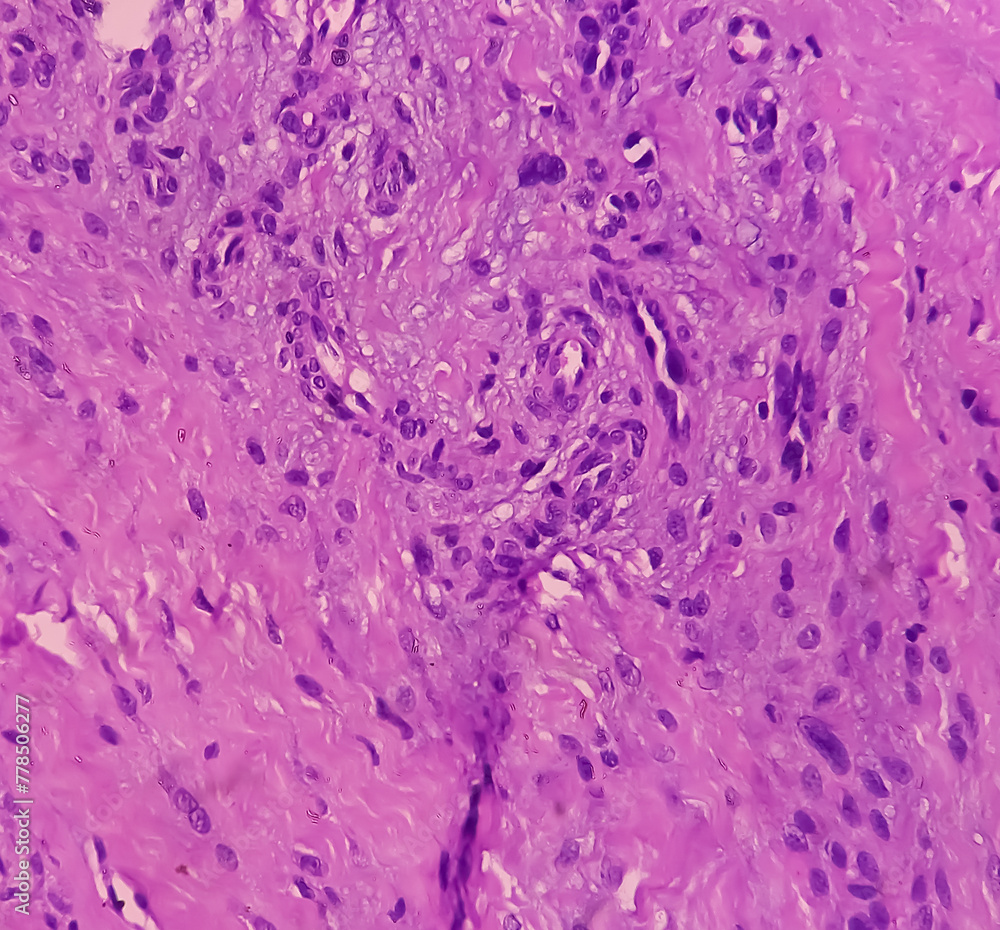 Tendon sheath (biopsy): Chronic synovitis. smear show area of fibrosis ...
