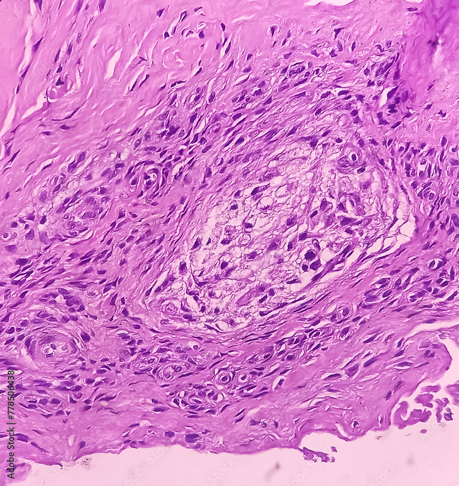 Tendon sheath (biopsy): Chronic synovitis. smear show area of fibrosis ...
