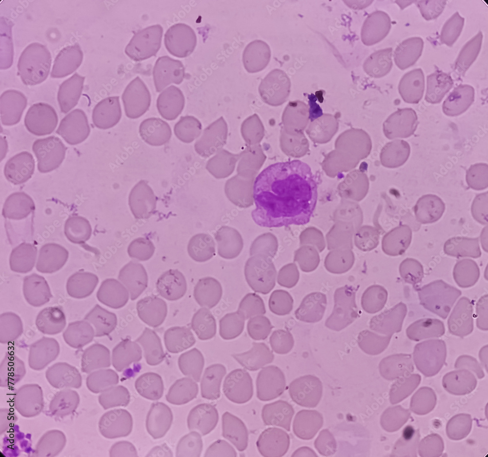 Blood smear show anisocytosis and target cells, Macrocytic anemia ...