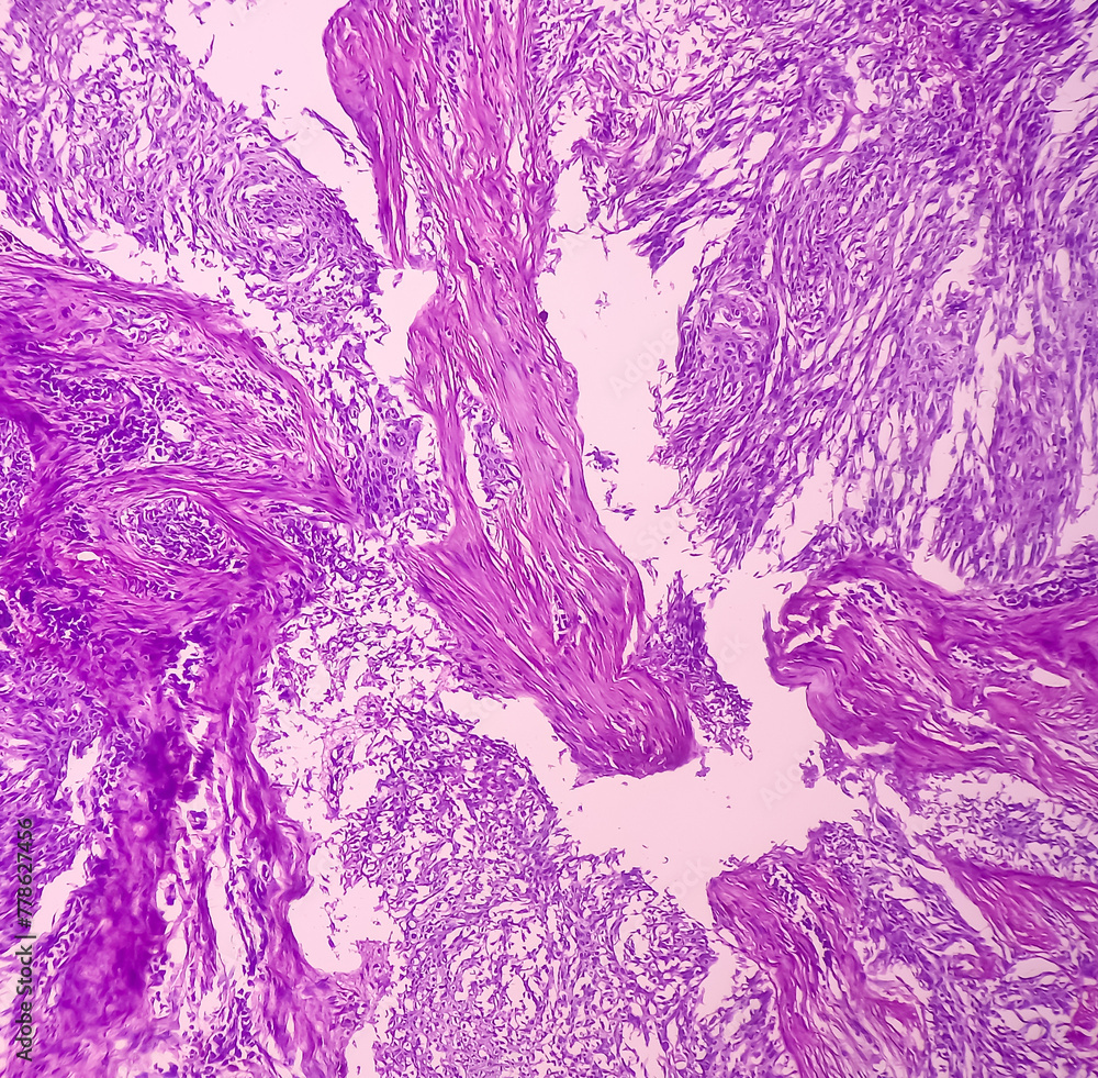 Nipple (biopsy): Invasive squamous cell carcinoma of nipple ...