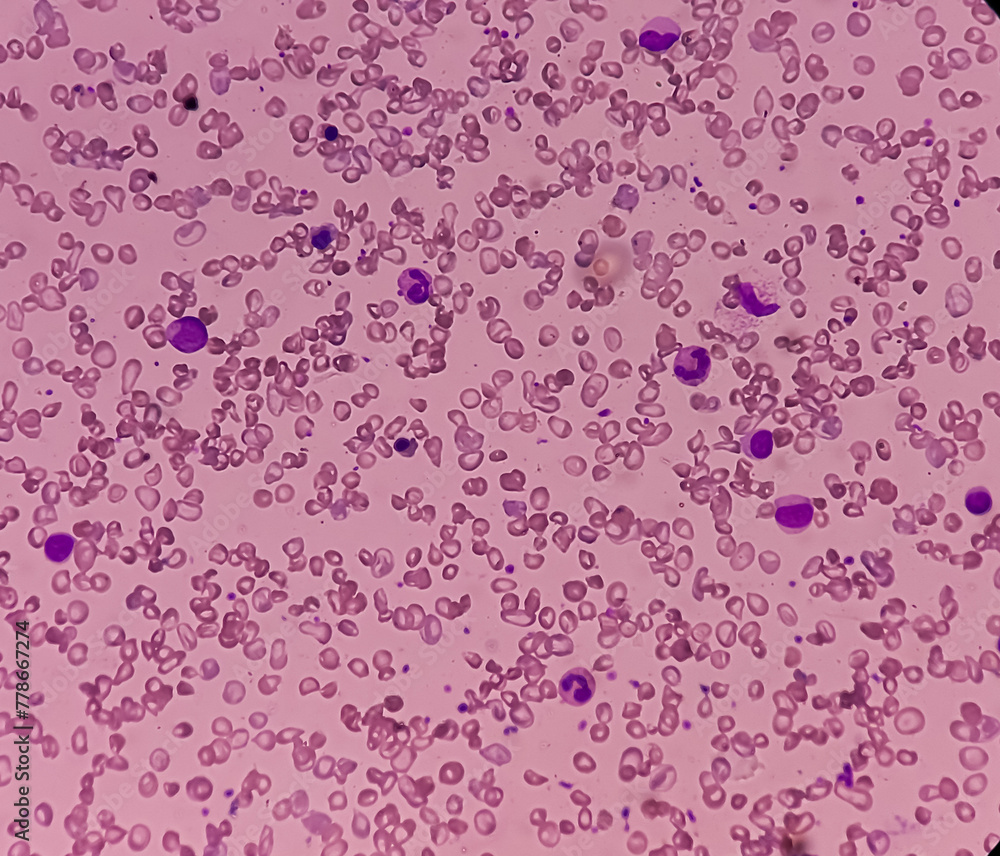 Photomicrograph of hematological slide showing RBC, WBC (Eosinophil ...