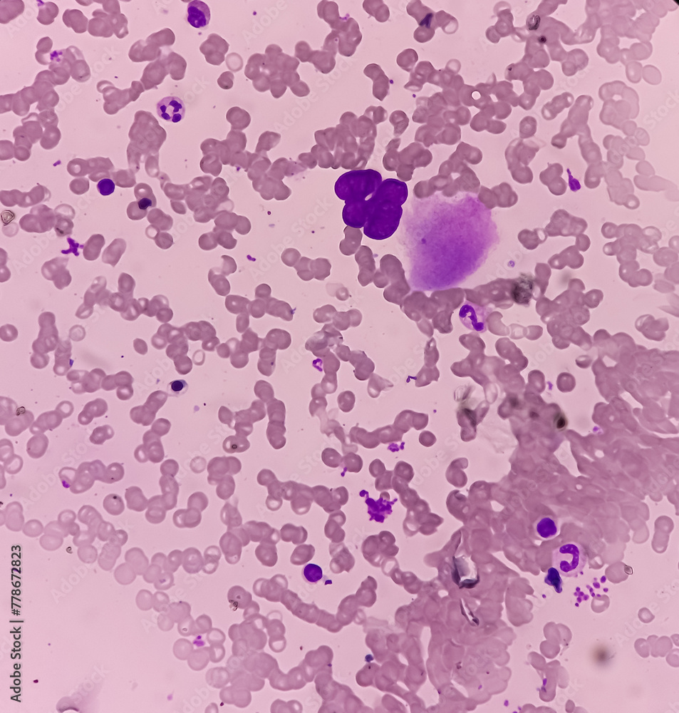 Acute leukemia, ALL(Acute lymphoblastic leukemia), peripheral blood ...