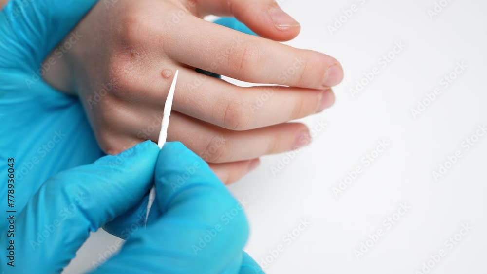 Dermatologist in medical gloves treats a child hand affected by warts ...