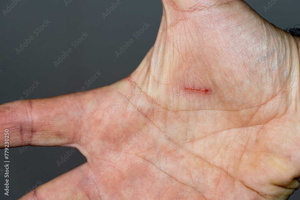 Part of human hand palm with wound caused by plant spikes Stock Photo ...