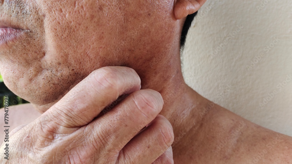 portrait the hand scratching the rash hives and allergy, reaction and ...