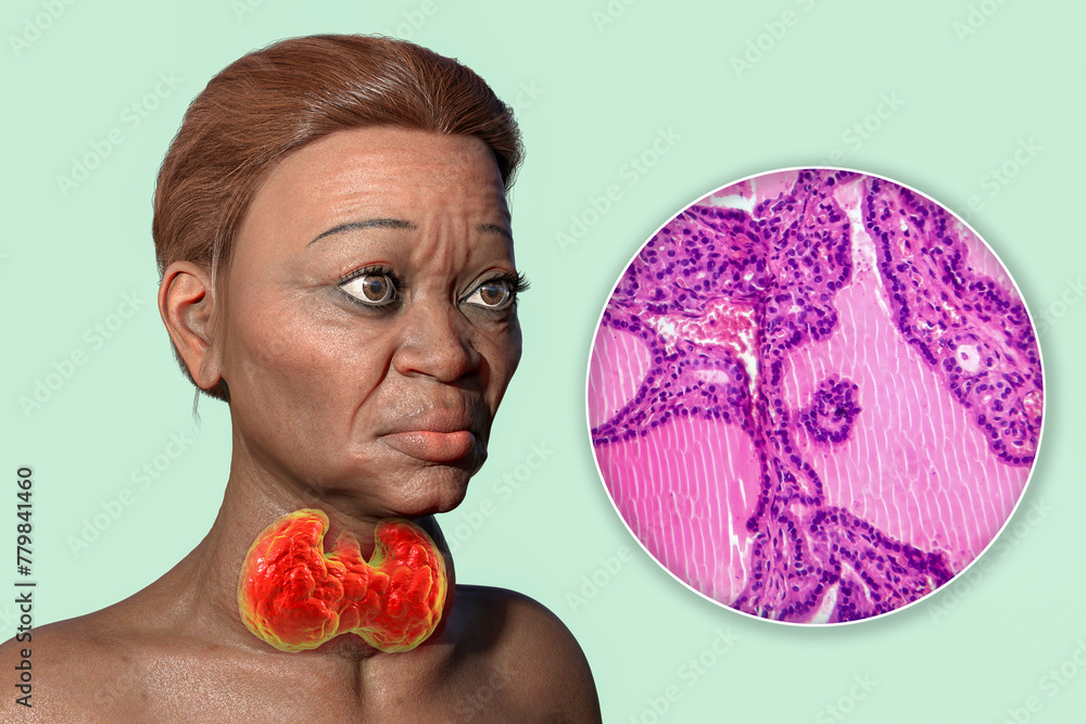 Póster Grave's disease in a woman, 3D illustration and light micrograph ...
