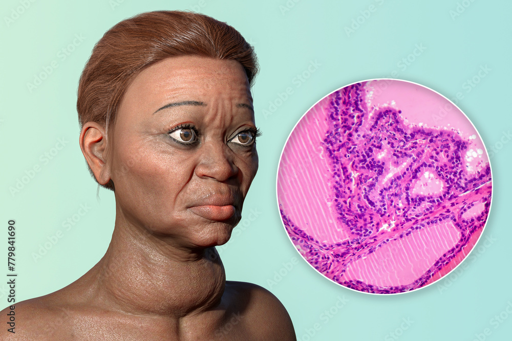Póster Grave's disease in a woman, 3D illustration and light micrograph ...