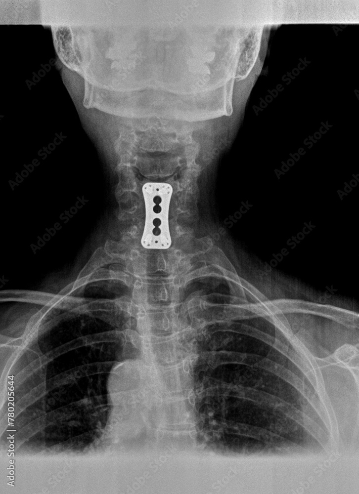 Film xray or radiograph of a cervical neck. AP anterior posterior view ...
