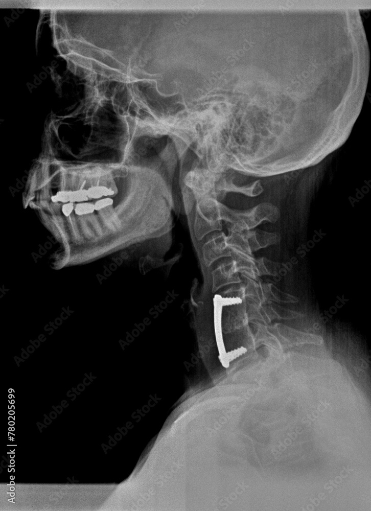 Film xray or radiograph of a cervical neck. Lateral side view showing ...