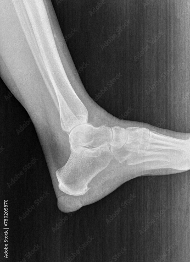 Foto de Film xray or radiograph of a normal foot, ankle and leg ...