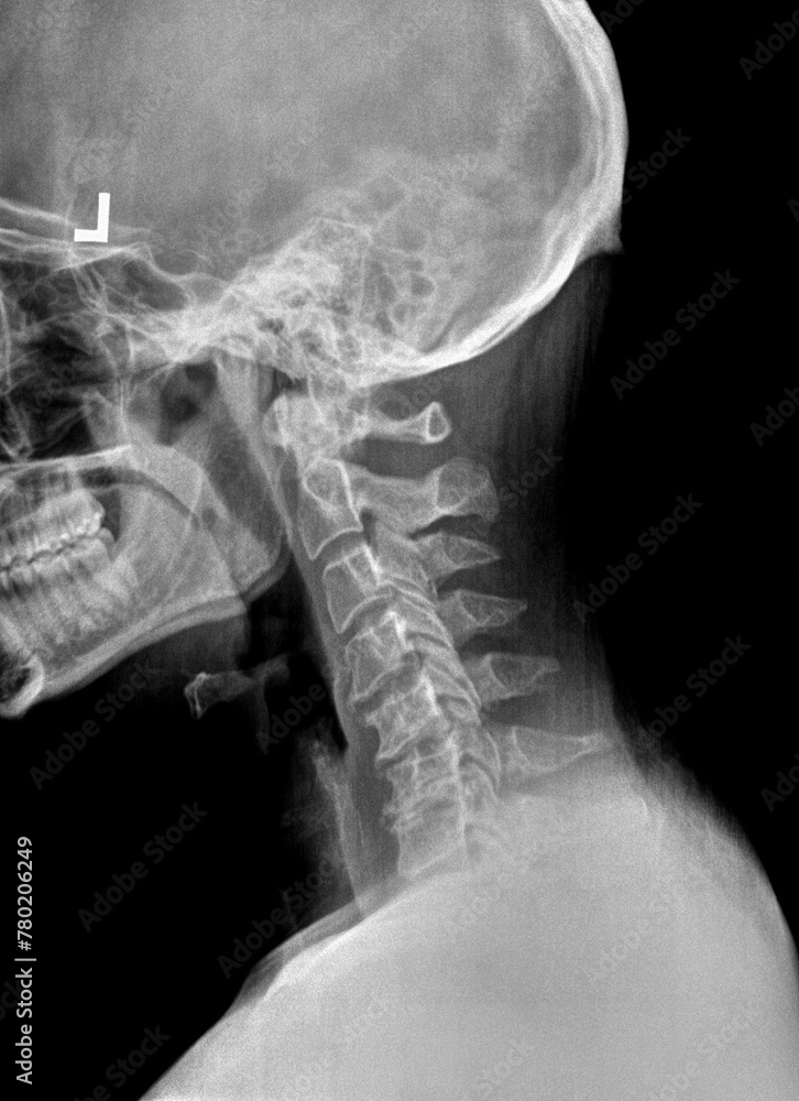 Film x ray or radiograph of a cervical neck. Lateral side view showing ...