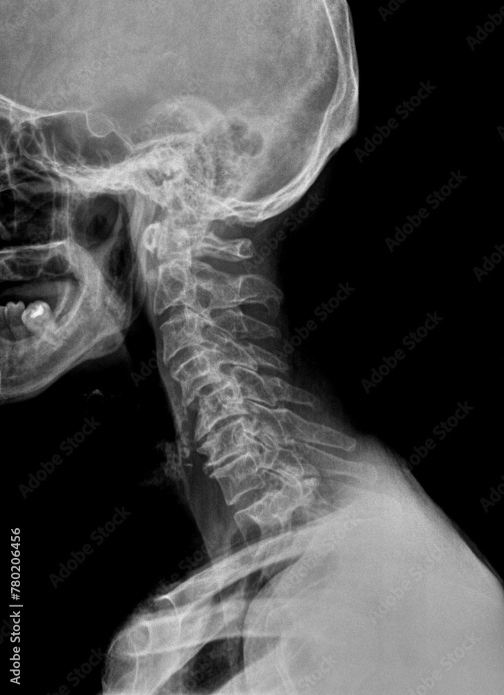Foto de Film x ray or radiograph of a cervical neck in an elderly ...
