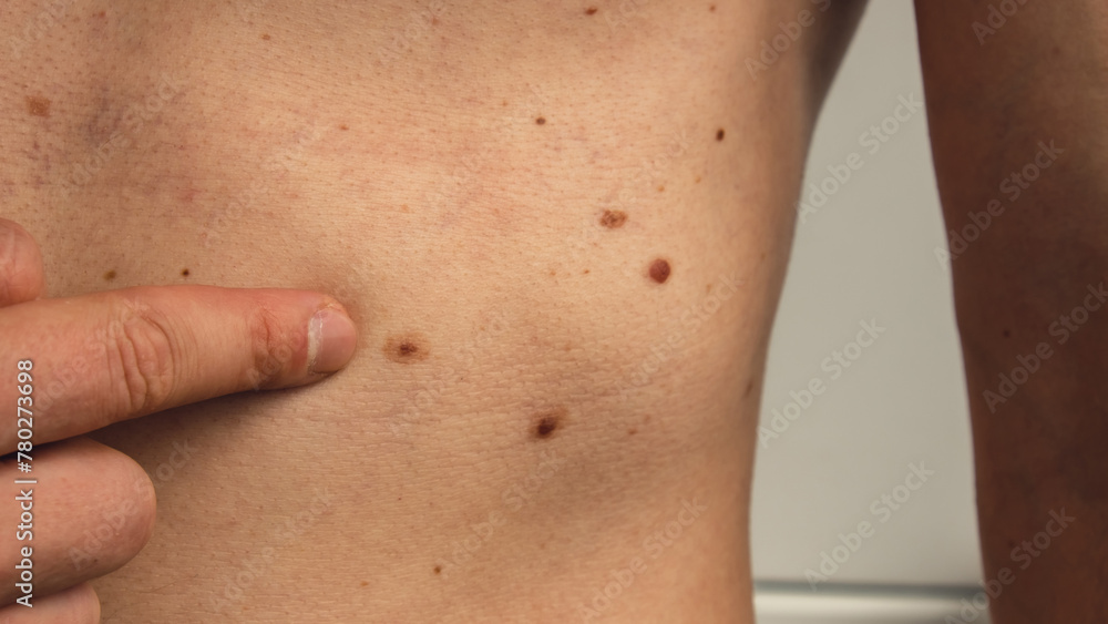 Male hand showing birthmarks on skin body stomach part. Close up detail ...