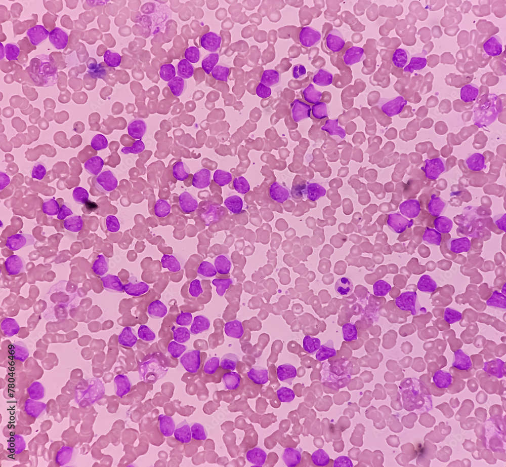 Acute leukemia, ALL(Acute lymphoblastic leukemia), peripheral blood ...