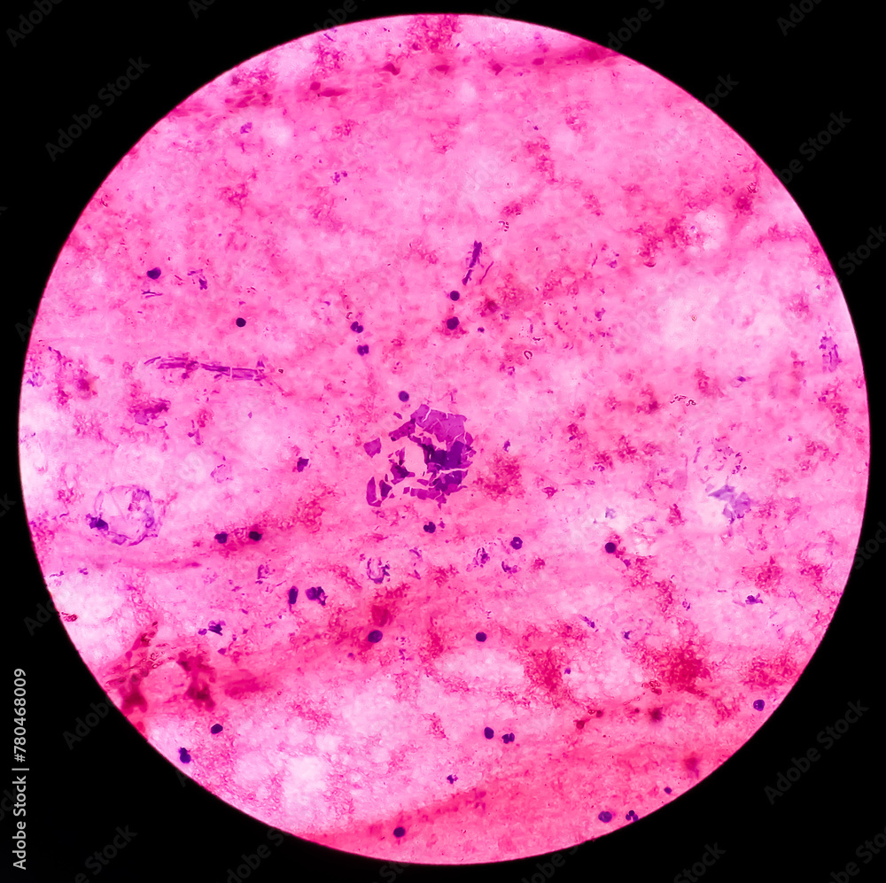 CT guided FNA from abduminal mass: Spindle cell neoplasm, smear show ...