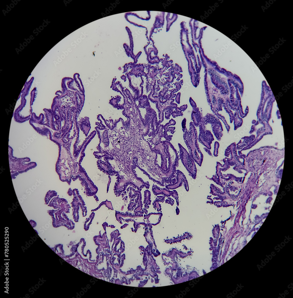 Microscopic image of Papillary borderline serous tumor of the ovary ...