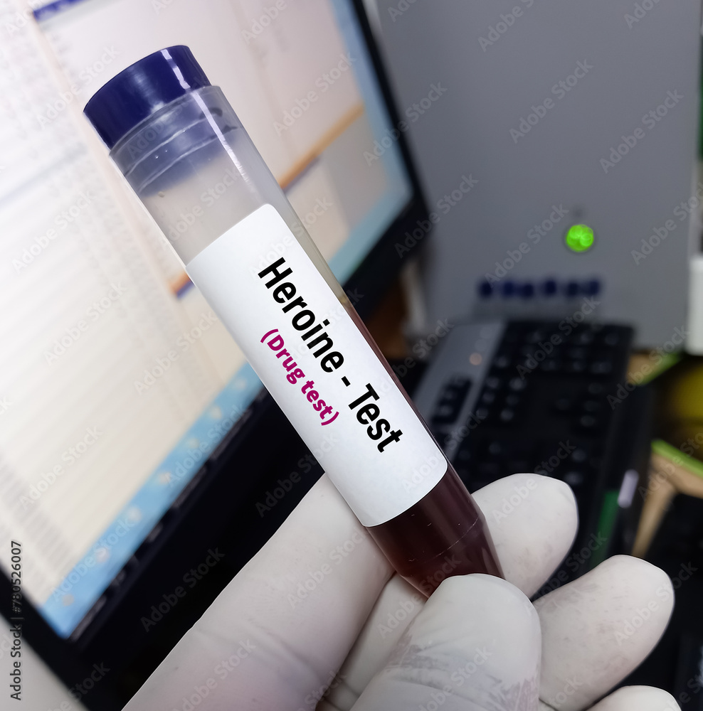 Urine sample for Heroine drug test, It's technical analysis of specimen ...