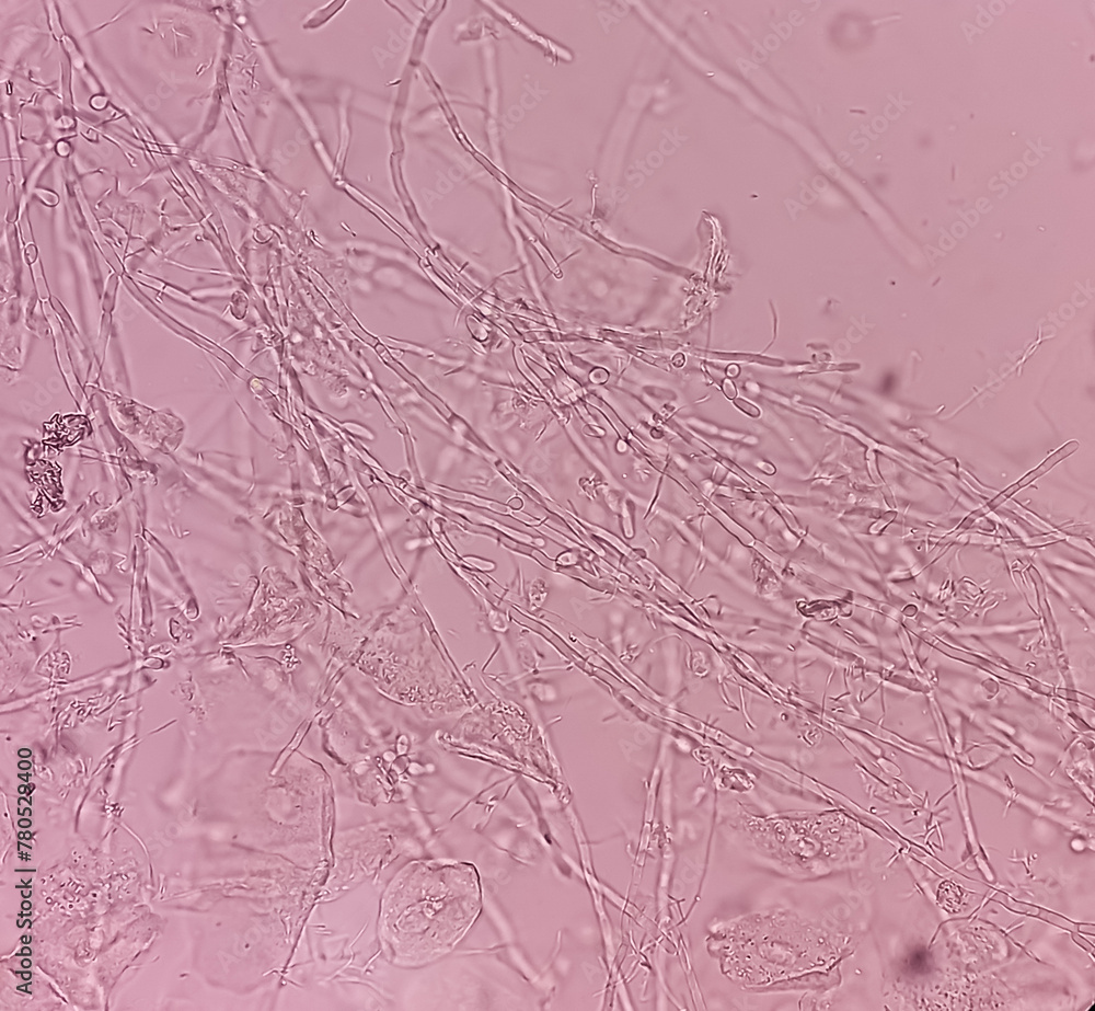 Foto de Pseudo hyphae and budding yeast cells in patient urine (urinary ...