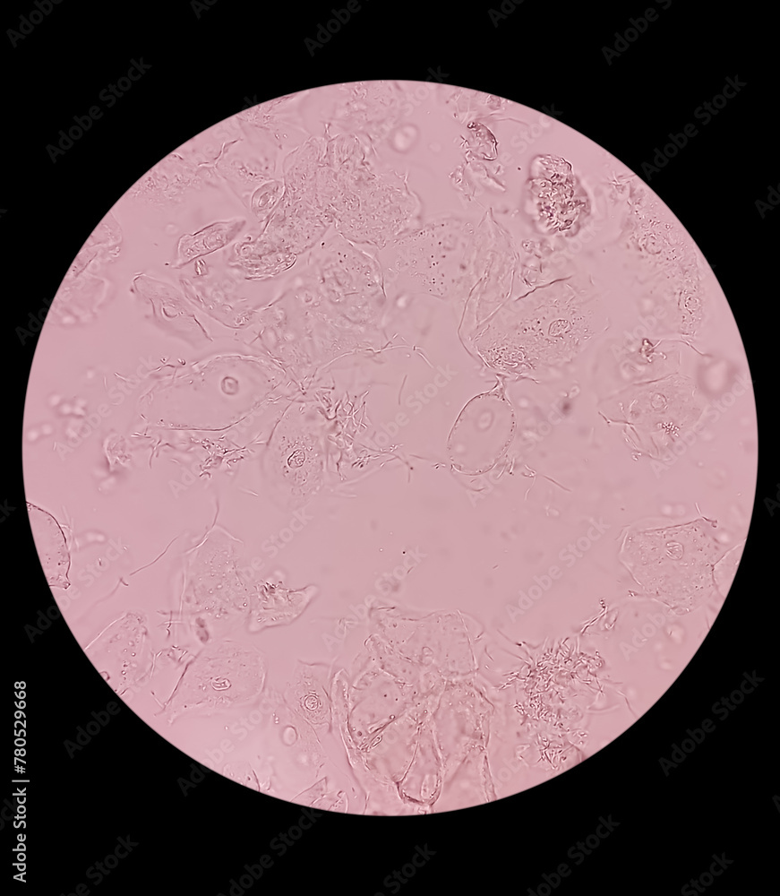 Microscopic image of urine sediment show epithelial cells. UTI. urine ...