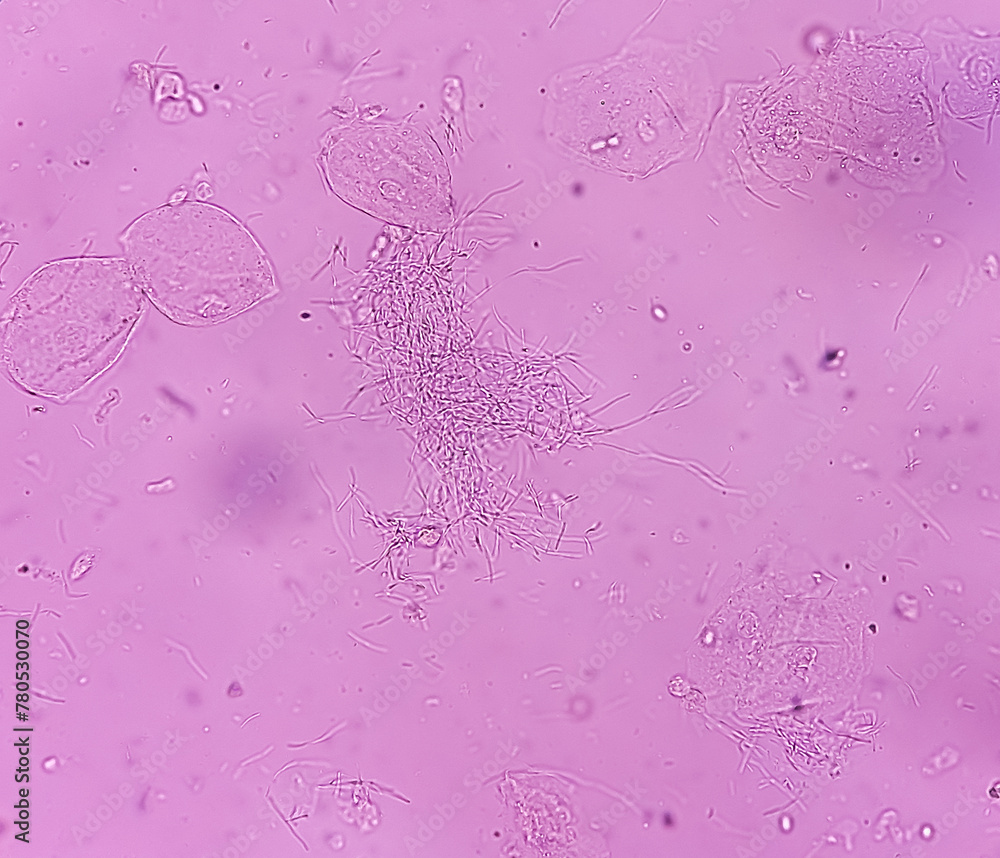 Pseudo hyphae and budding yeast cells in patient urine (urinary tract ...