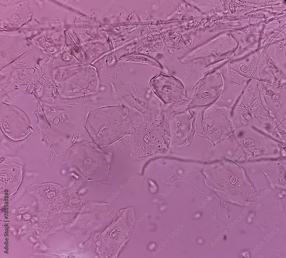 Pseudo hyphae and budding yeast cells in patient urine (urinary tract ...
