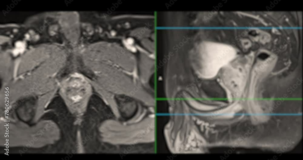 MRI of the prostate gland, revealing an enlarged size, aids in ...