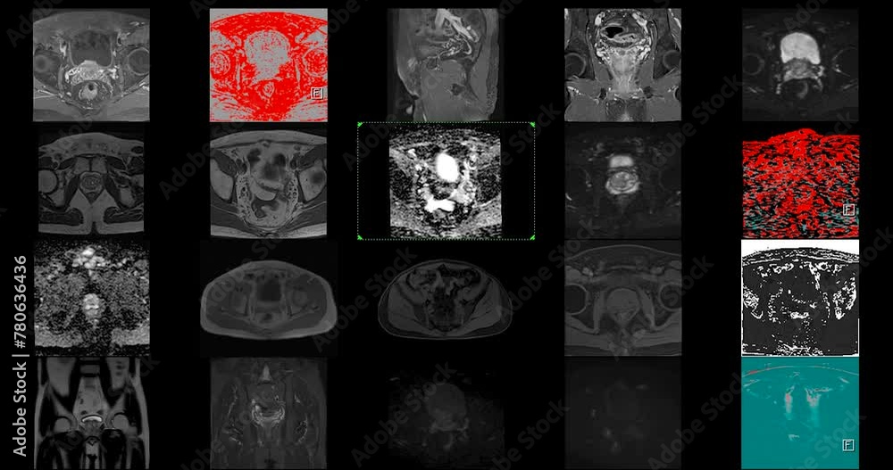 MRI of the prostate gland, revealing an enlarged size, aids in ...