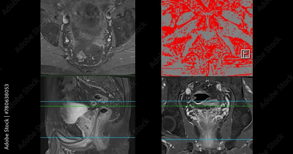 Vidéo Stock MRI of the prostate gland, revealing an enlarged size, aids ...
