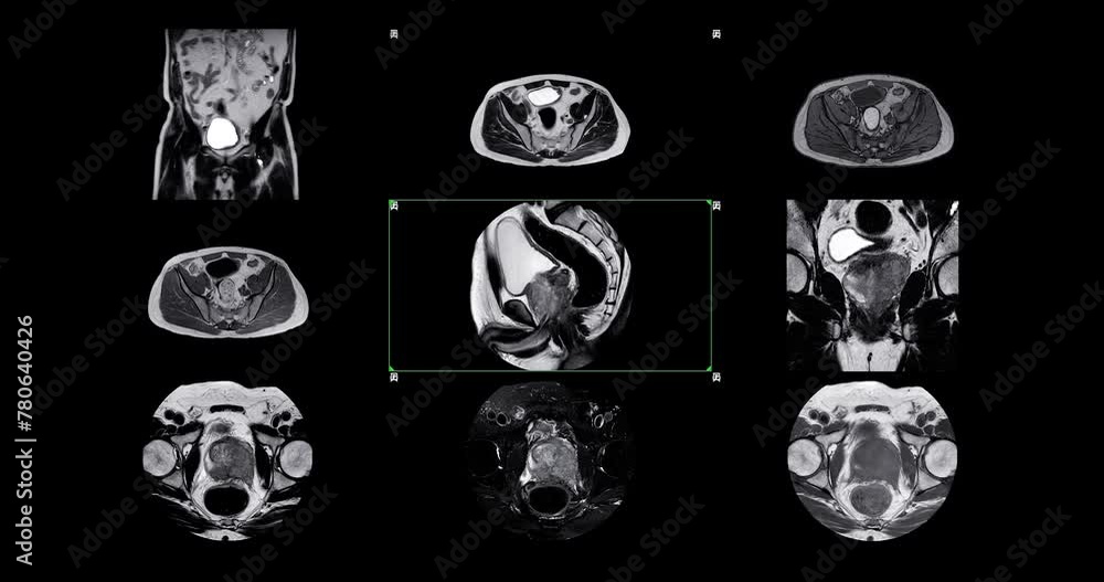 MRI of the prostate gland reveals a focal abnormal signal intensity (SI ...