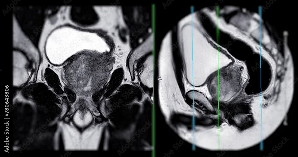 MRI of the prostate gland reveals a focal abnormal signal intensity (SI ...