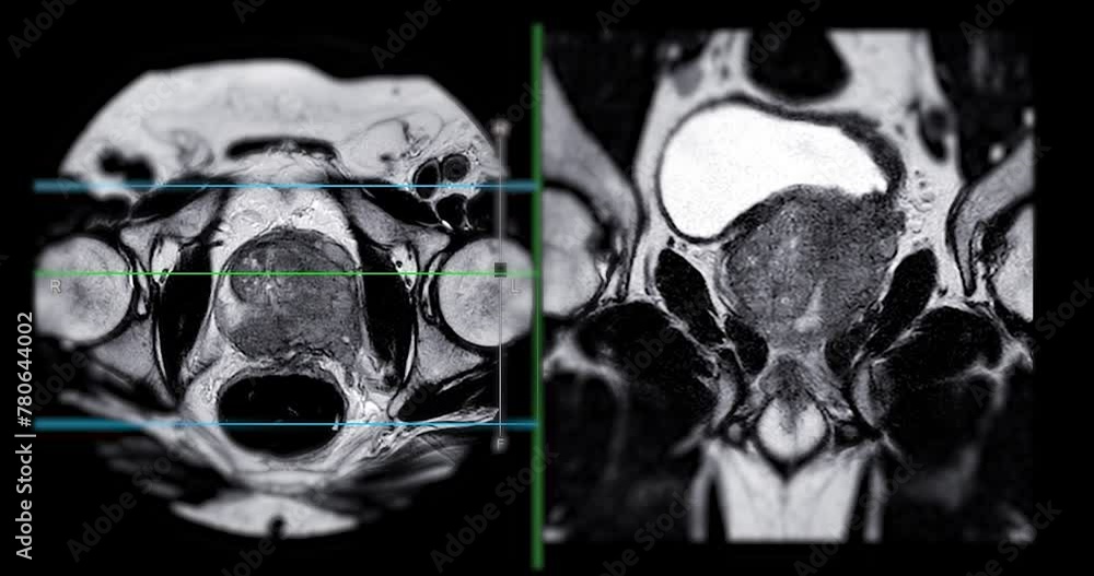 Vidéo Stock MRI of the prostate gland reveals a focal abnormal signal ...