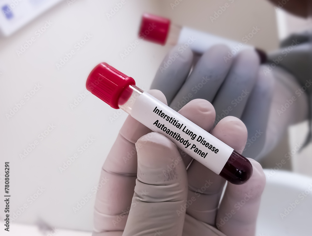 Blood sample for Interstitial Lung Disease autoantibody panel test. to ...