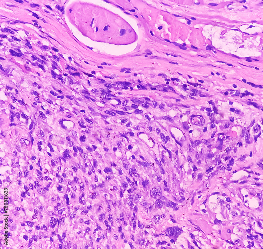 Bone cancer. Chondroblastic osteosarcoma. It's very rare cancer ...