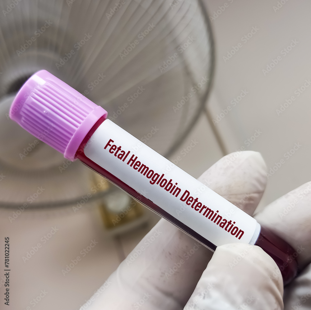 Blood sample for Fetal Hemoglobin Determination test to diagnosis of ...