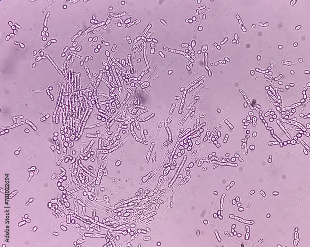 Microscopic fungi Malassezia furfur, showing yeast cells and hyphae ...