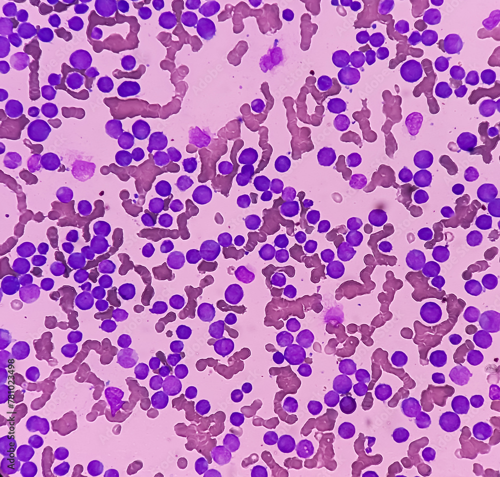 Acute myeloid leukemia (AML). Smear show monocytes and mostly blast ...