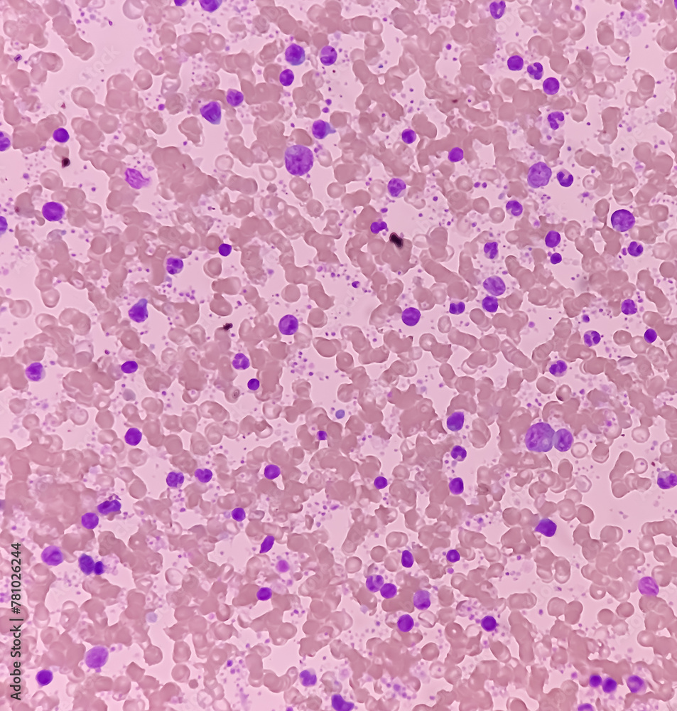 Microscopic image showing Chronic myeloid leukaemia (CML) is a type of ...