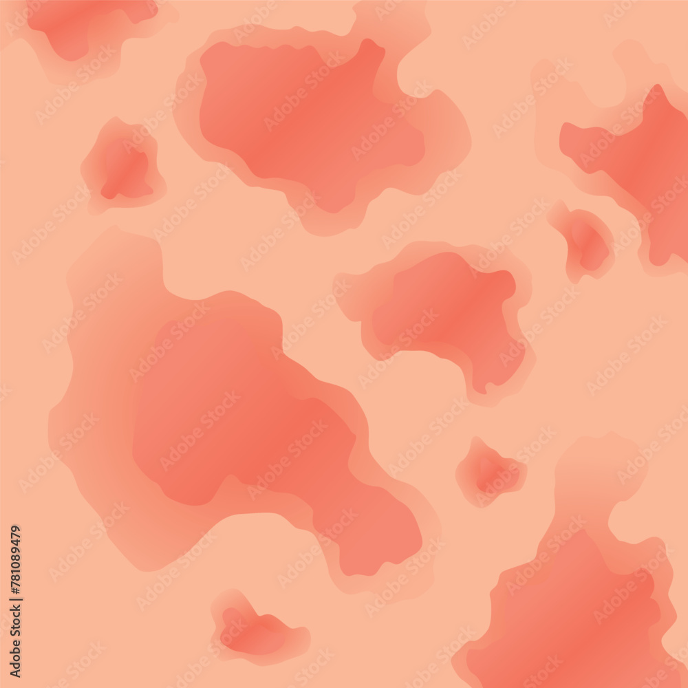 Type of psoriasis vector. Part of patients skin with dermatitis ...