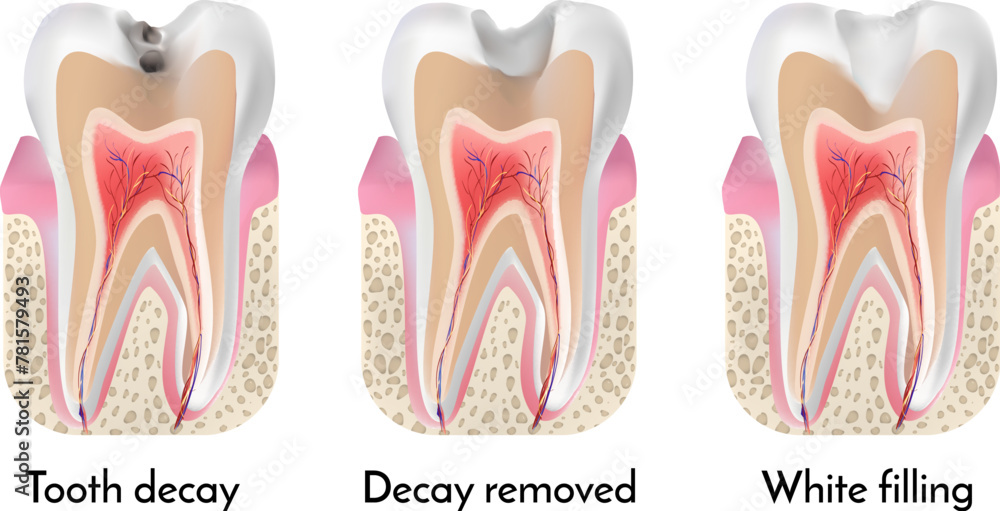 Tooth treatment stages. Tooth decay, decay removed, white filling Stock ...