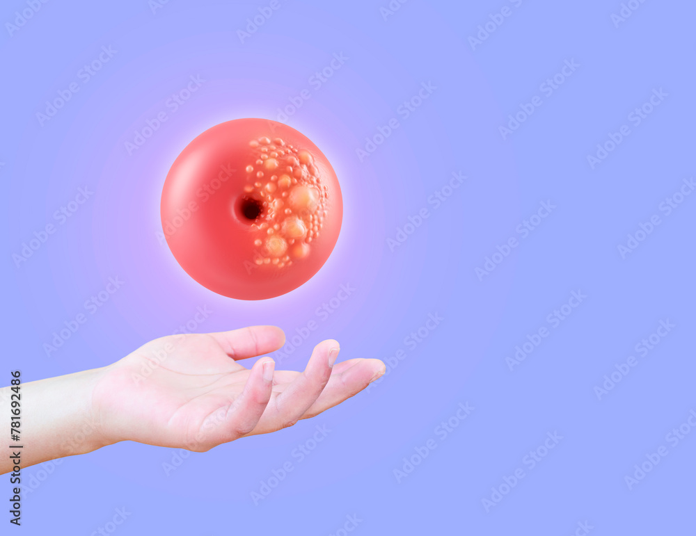 Poster Cervical cancer seen from a speculum – Wall Art | UkPosters