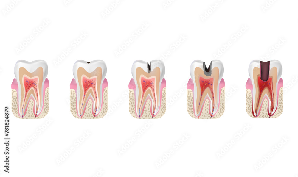 Stages of caries and healthy tooth vector illustration. Superficial ...