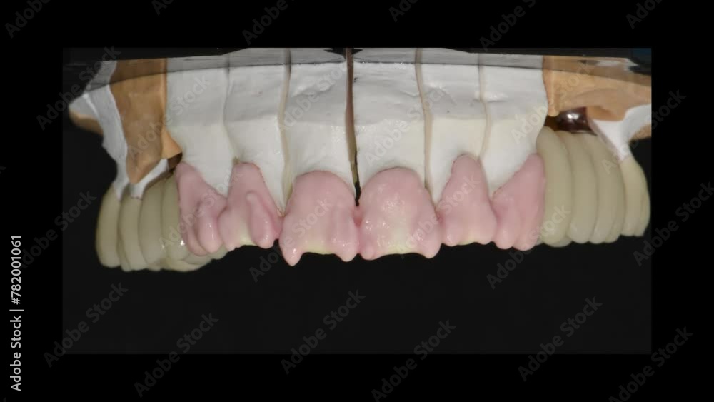 Vidéo Stock Aesthetic ceramic veneers on the front teeth. Dental ...