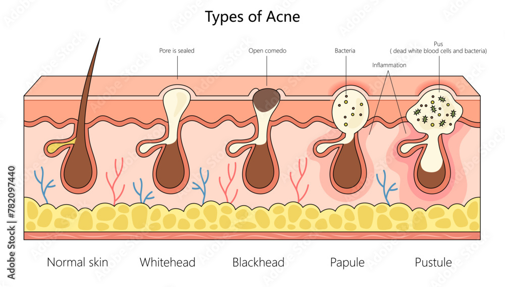 various acne types, from normal skin to inflamed pustules, for ...