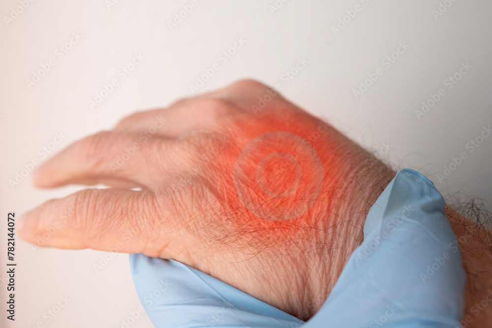 hand elderly man with inflamed tendon from rheumatism, doctor ...