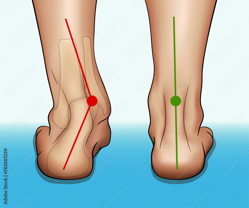 Vector illustration in realistic style depicting the medical problem of ...