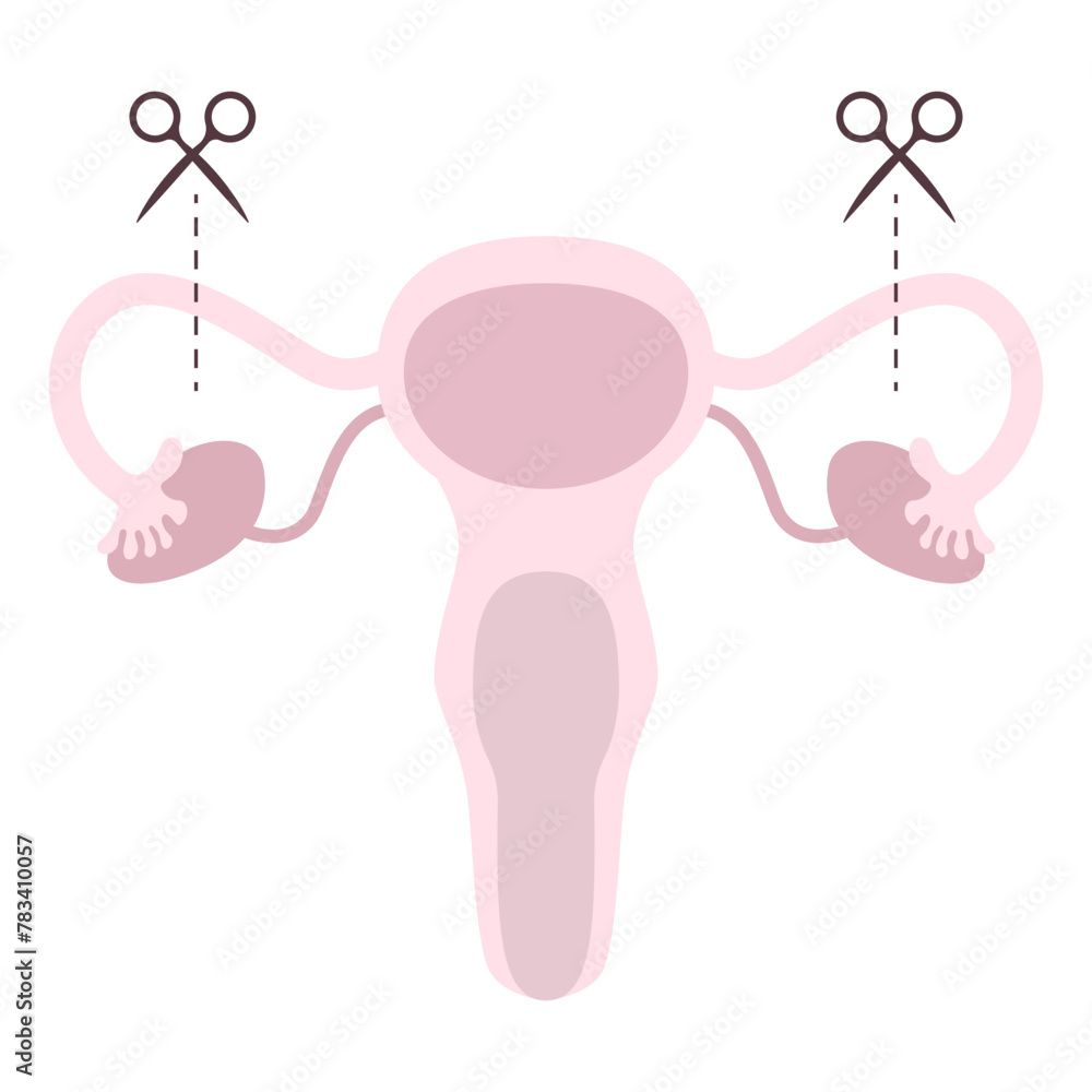 Tubectomy Reversal. Tubal ligation or surgical procedure tubectomy in ...