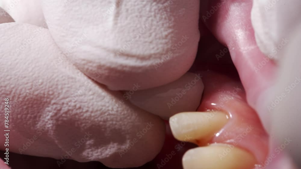 Vidéo Stock Close-up macro shot of installing ceramic crowns to female ...