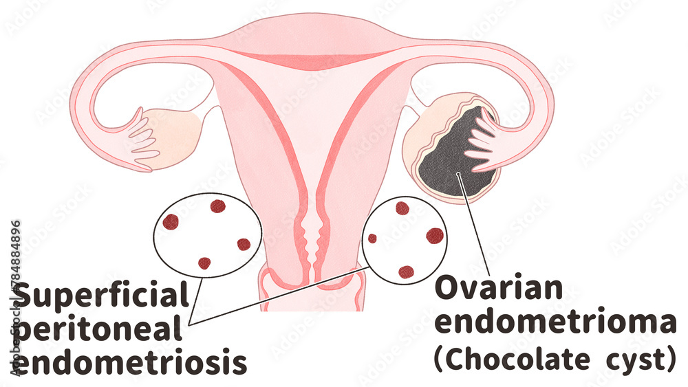 Types of Endometriosis Labeled diagram Superficial peritoneal endometriosis Ovarian endometrioma ...