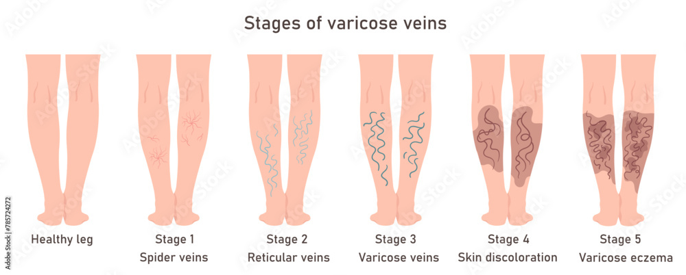 Stages of varicose veins. Varicose veins in women. Image of healthy and ...